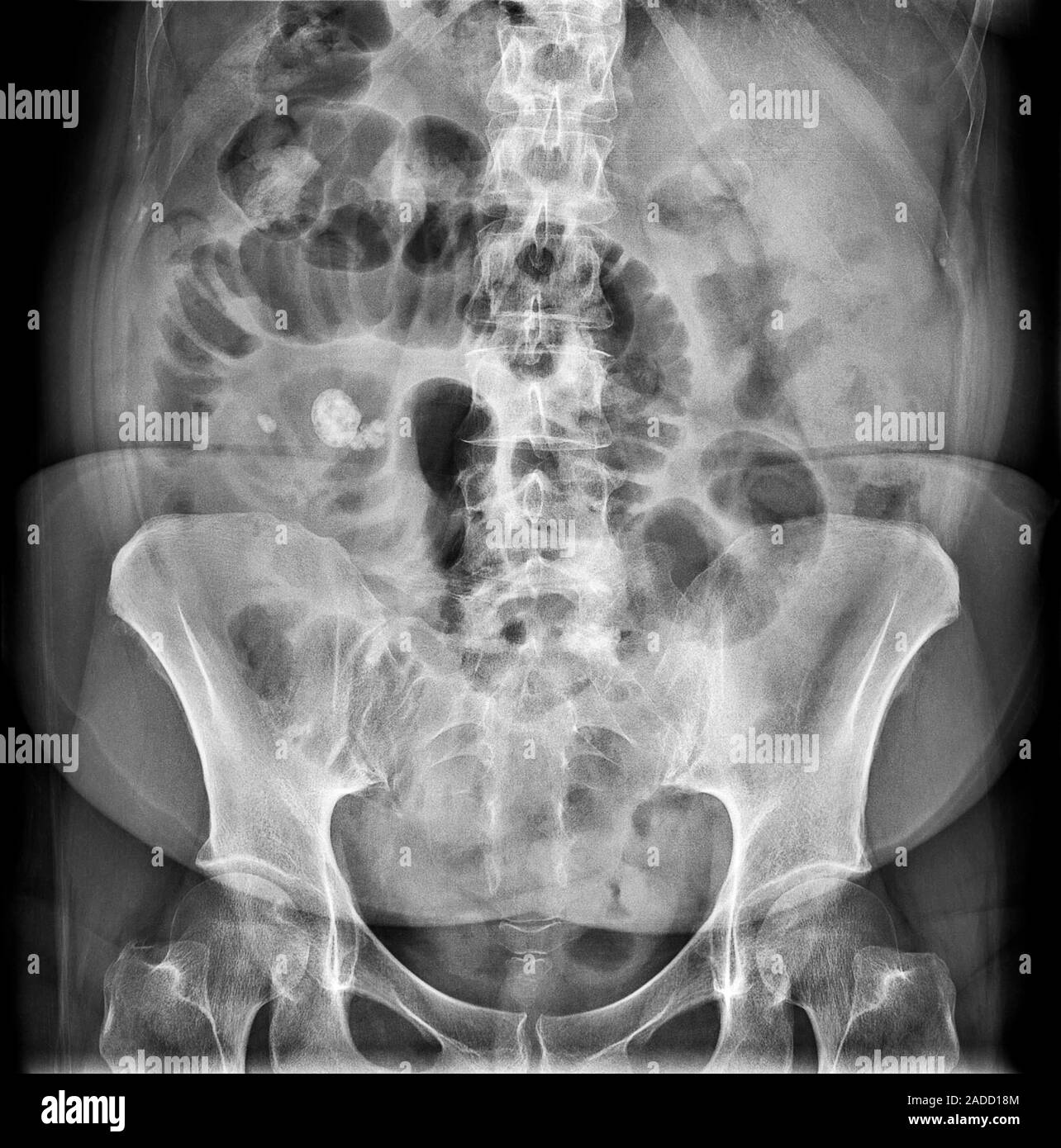 Situs inversus, lower abdominal X-ray. Situs inversus is a condition ...