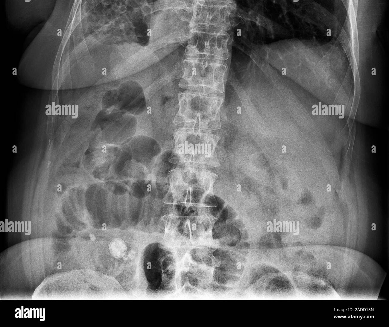 Situs inversus, upper abdominal X-ray. Situs inversus is a condition ...