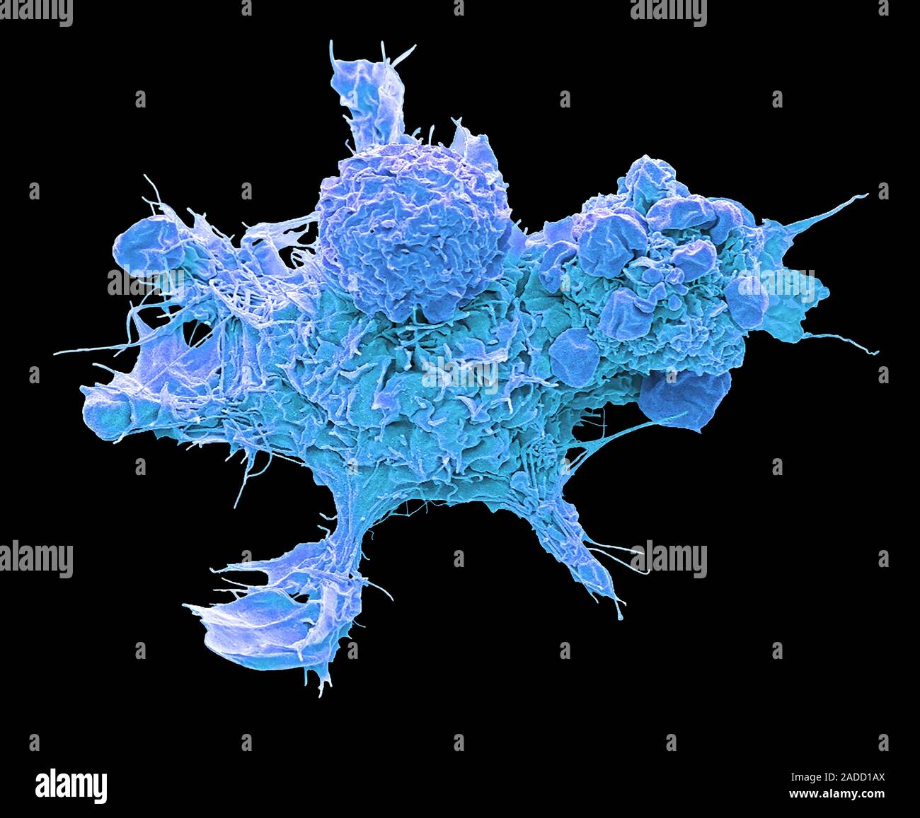 Adenovirus infected 293T cell in culture, coloured scanning electron ...