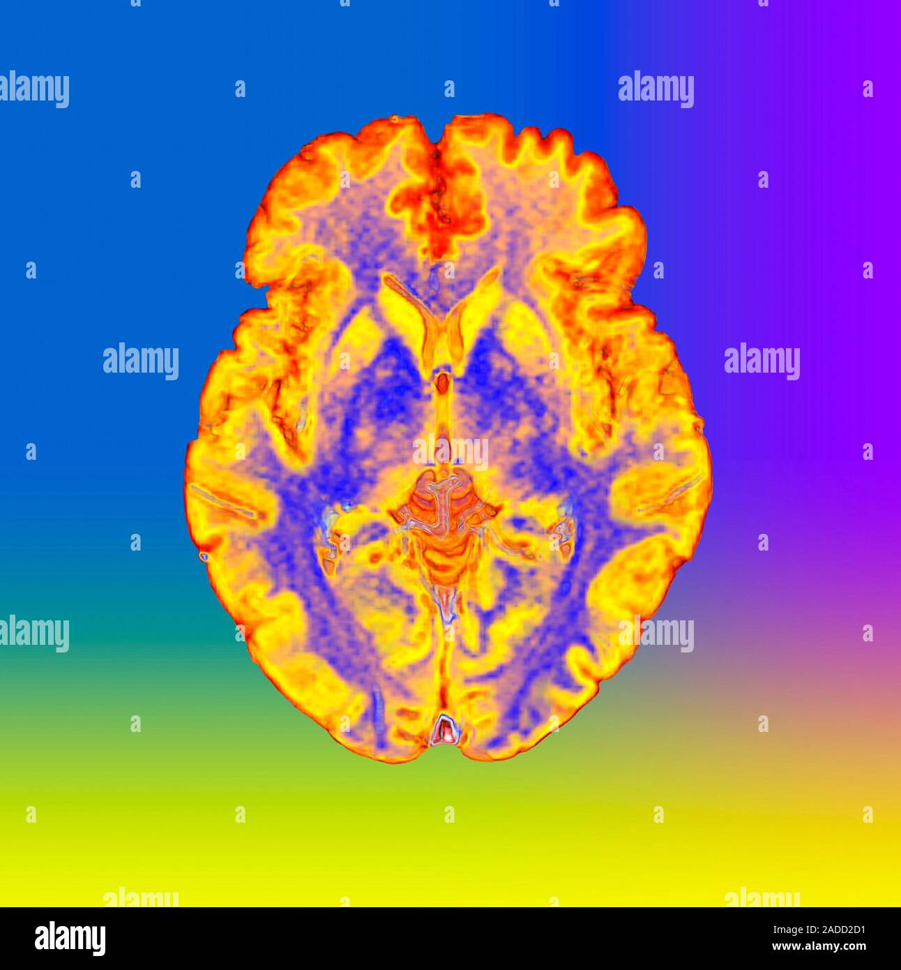 Human brain, coloured axial magnetic resonance imaging (MRI) scan. This region of the brain ...