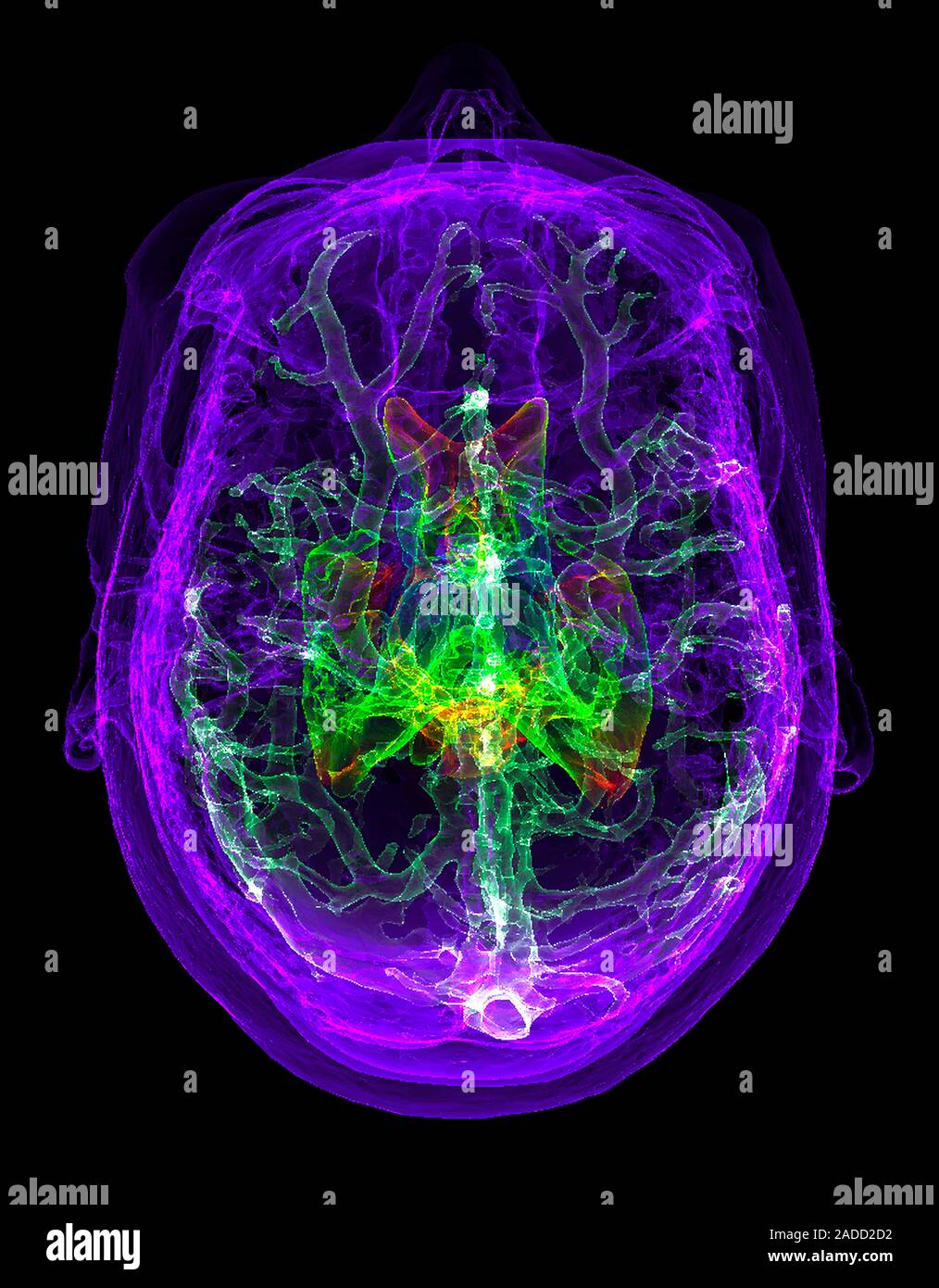 Human skull and brain, coloured 3D magnetic resonance imaging (MRI) scan. This view from above ...