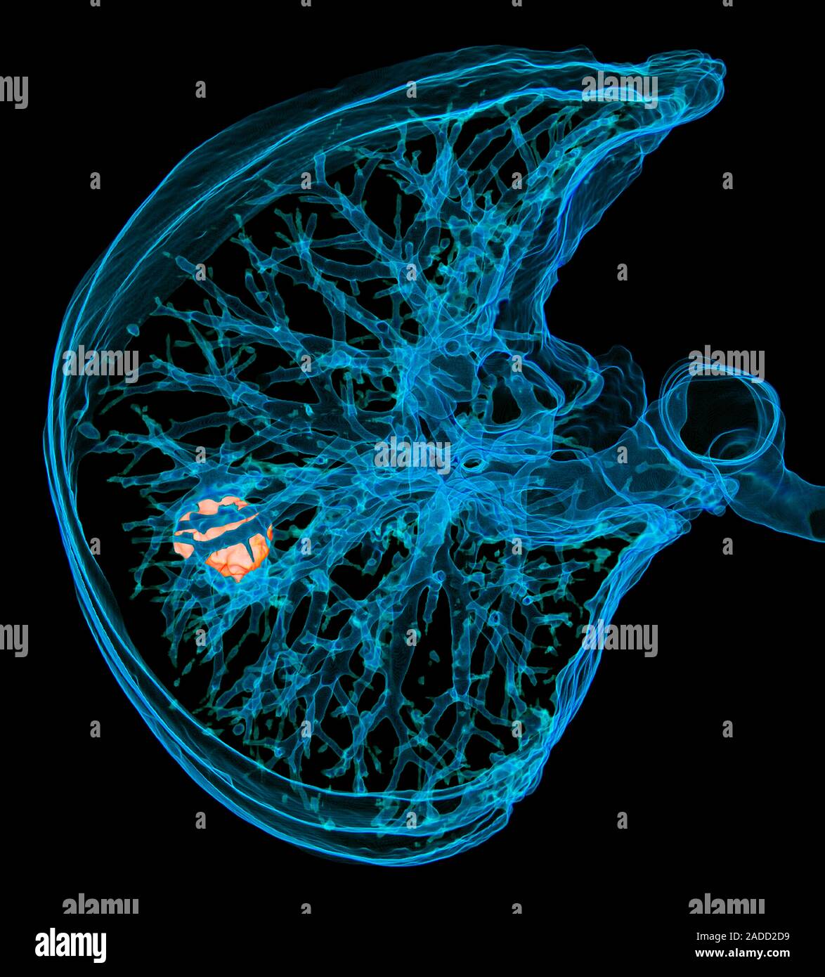 Lung cancer. Coloured 3D computed tomography (CT) scan of the airways ...