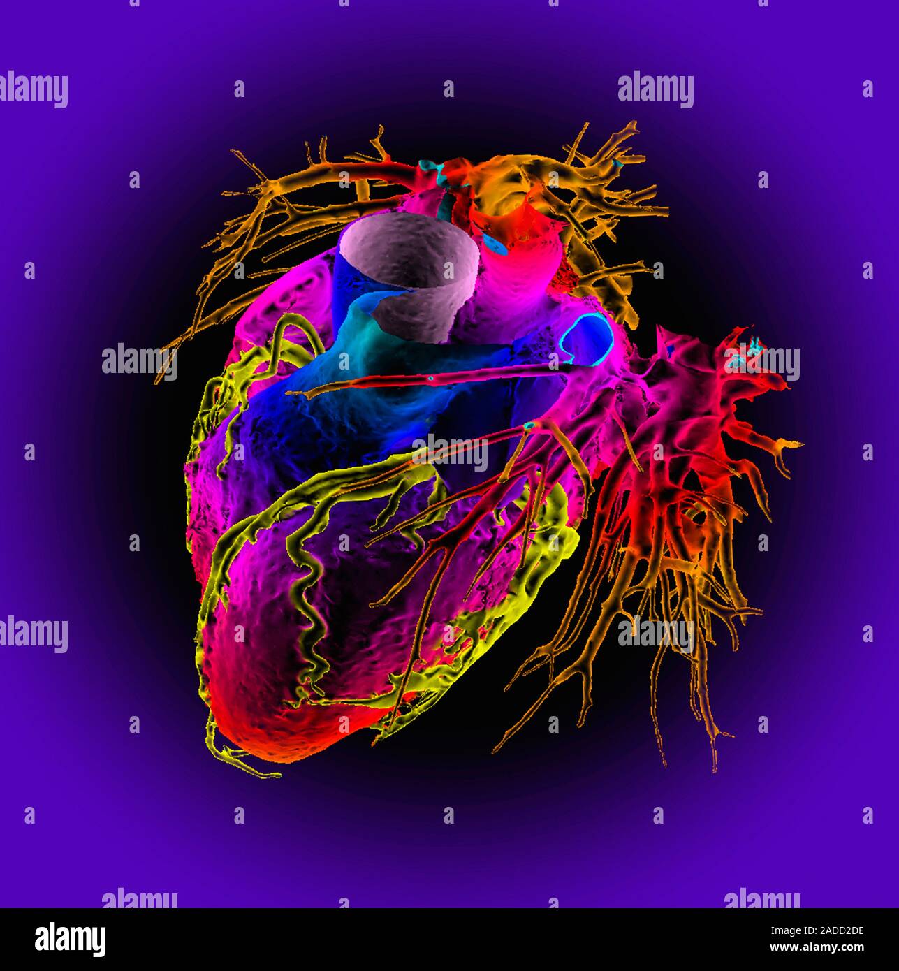 Human heart, 3D coloured computed tomography (CT) angiogram. This is an ...