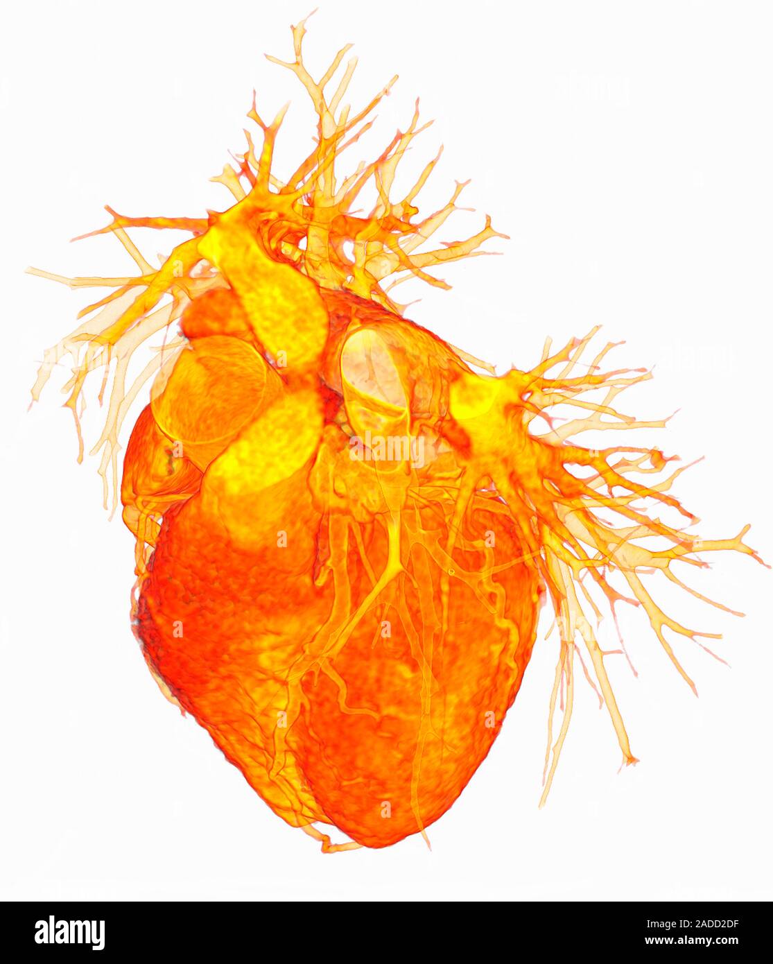 Human heart, 3D coloured computed tomography (CT) angiogram. This is a ...