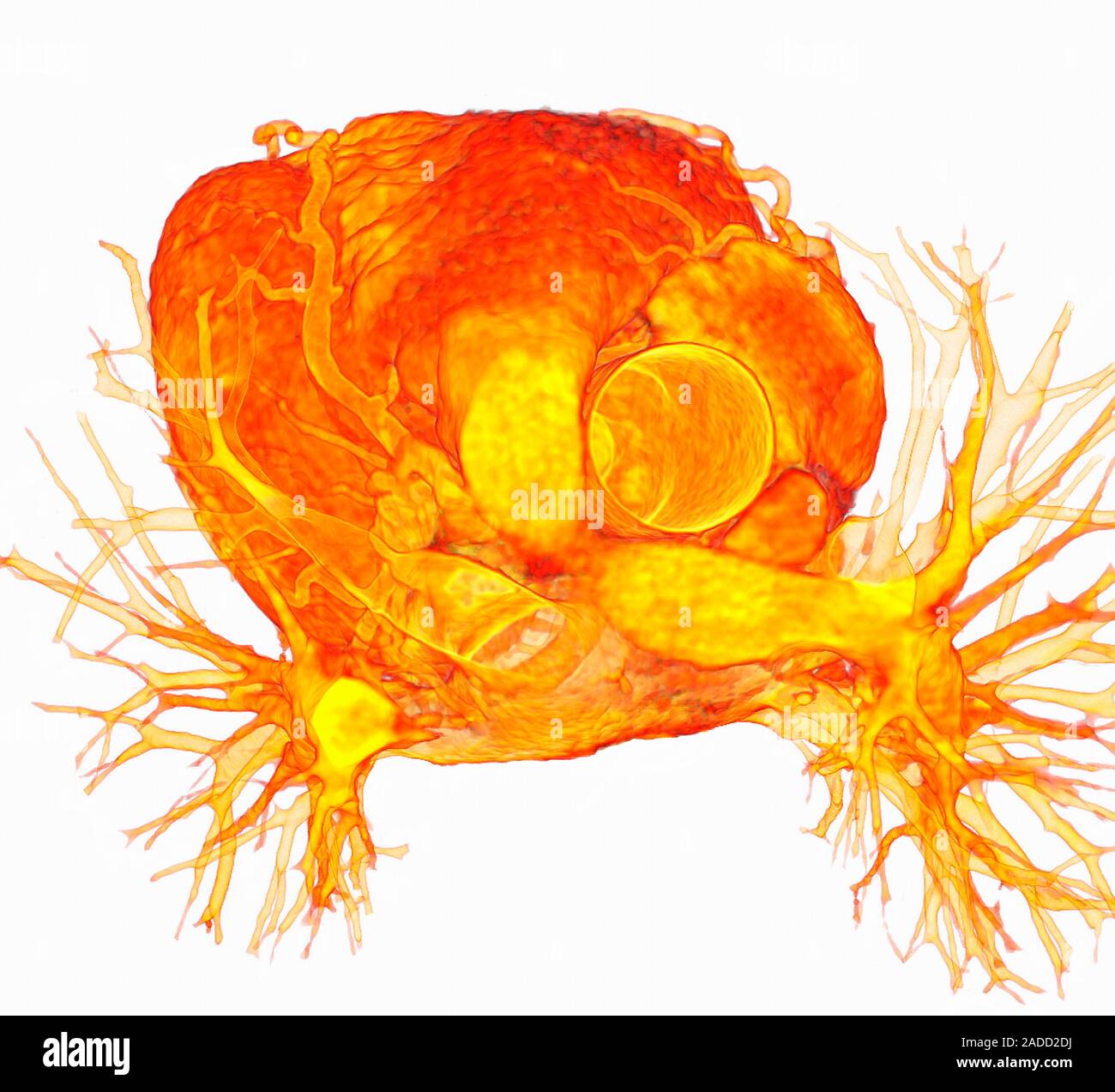 Human heart, 3D coloured computed tomography (CT) angiogram. This is a ...
