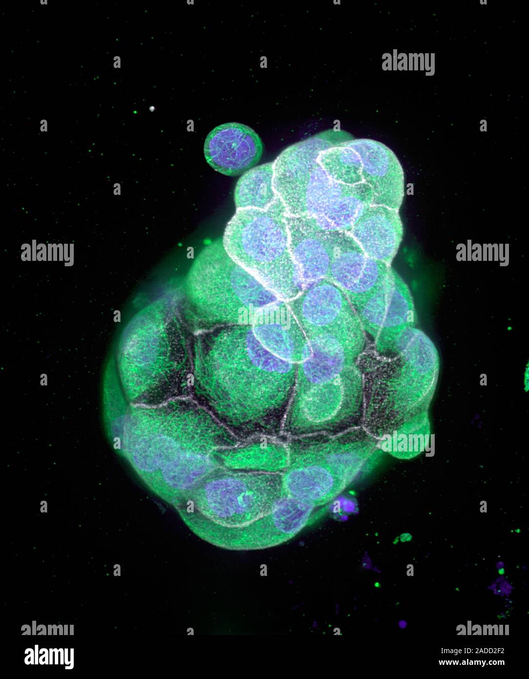 Fluorescence micrograph of human colon cancer cells in a three ...