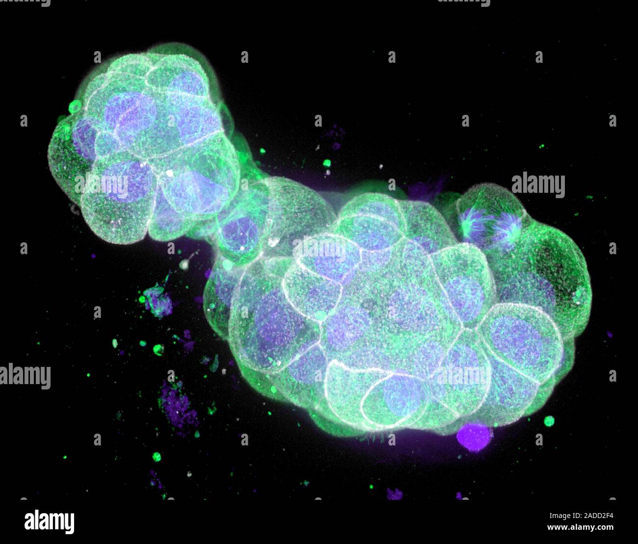 Fluorescence micrograph of human colon cancer cells in a three ...