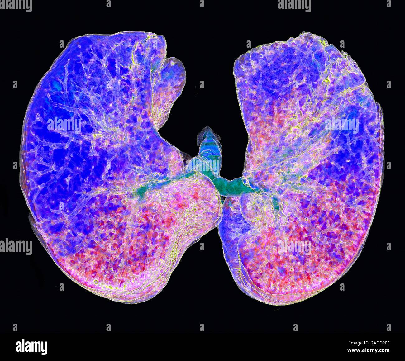 Interstitial lung disease. 3D computed tomography (CT) scan of the ...