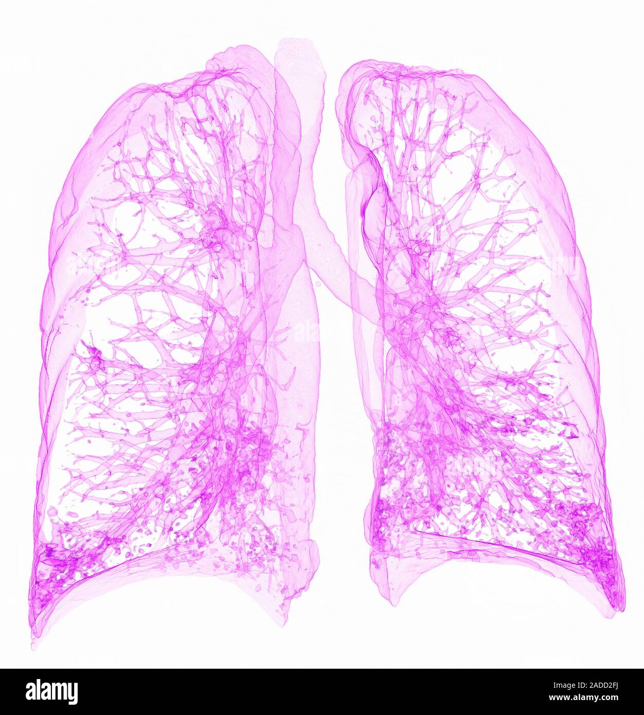 Miliary tuberculosis. Coloured 3D computed tomography (CT) scan of the lungs of a patient with ...