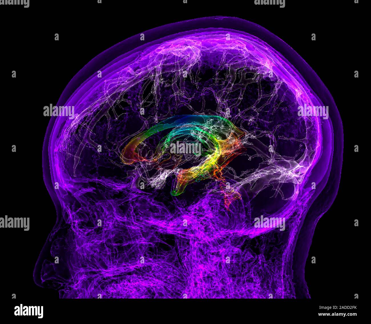 Human skull and brain, coloured 3D magnetic resonance imaging (MRI) scan. This view from the ...