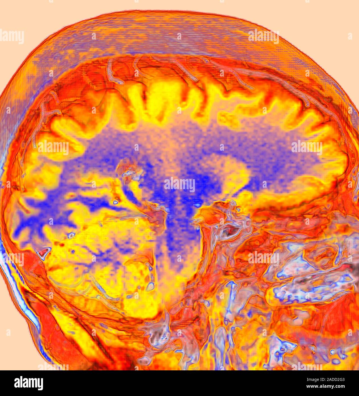 Human brain, coloured sagittal magnetic resonance imaging (MRI) scan. This section passes ...