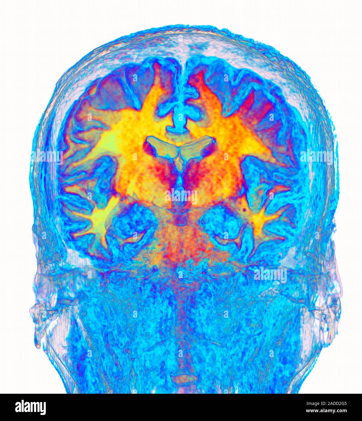 Human brain, coloured coronal magnetic resonance imaging (MRI) scan. This region of the brain ...