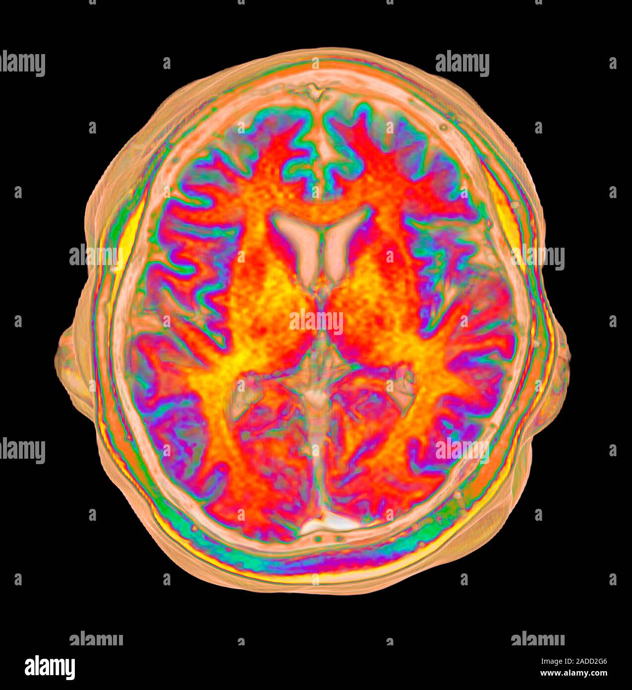 Human brain, coloured axial magnetic resonance imaging (MRI) scan. This region of the brain ...