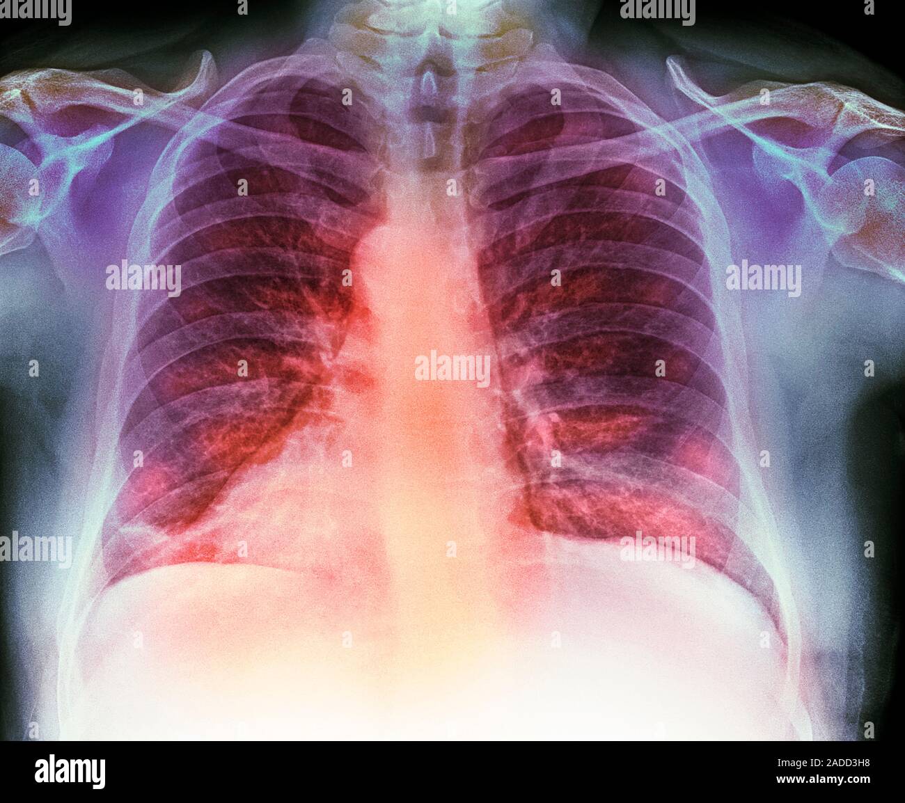 Reversed heart position. Coloured X-ray of the heart and lungs of a 49 ...