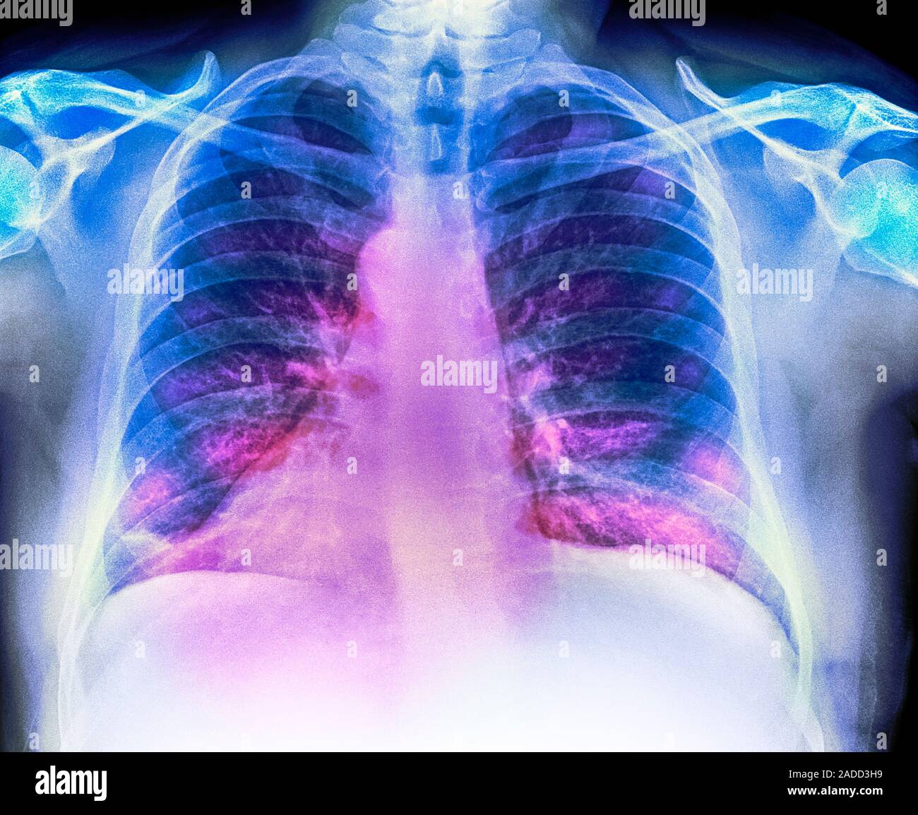 Reversed heart position. Coloured X-ray of the heart and lungs of a 49 ...