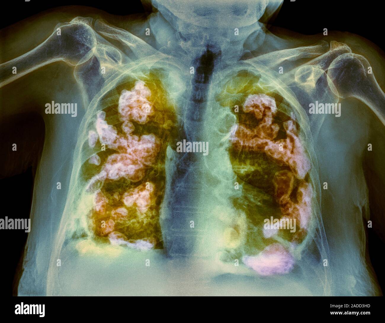 Bilateral pleural calcification, coloured X-ray. The pleura are the ...