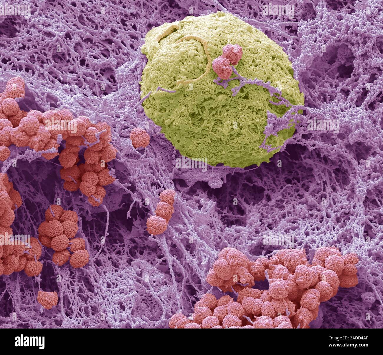 Sputum. Scanning electron micrograph (SEM). Phlegm is a secretion in ...