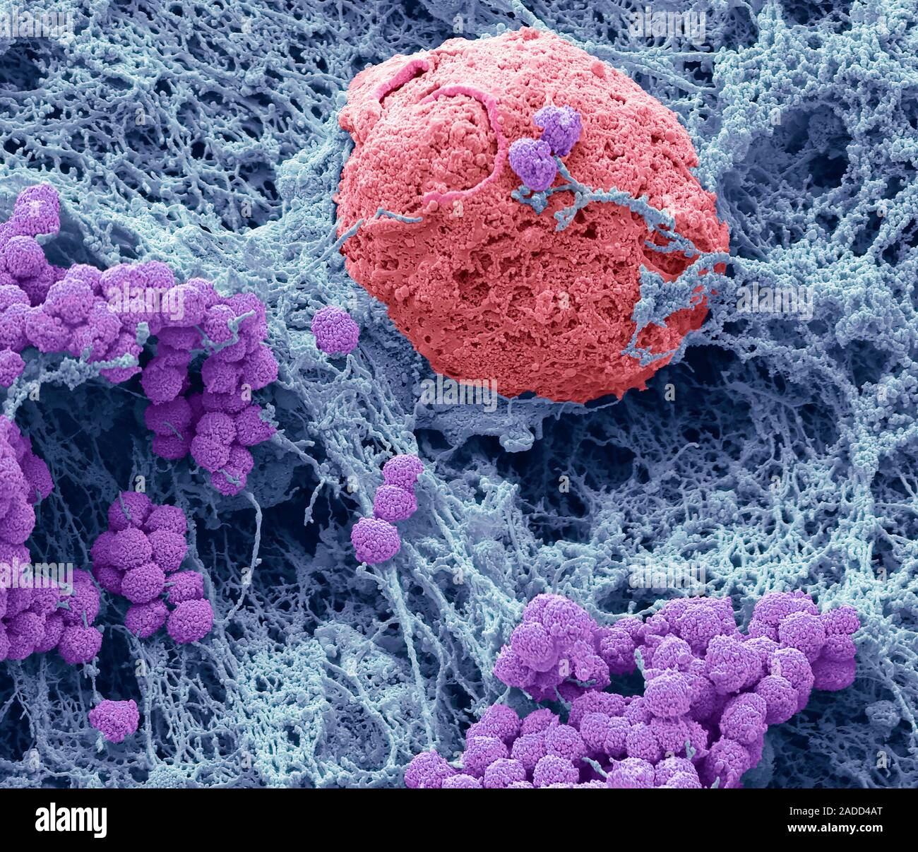 Sputum. Scanning electron micrograph (SEM). Phlegm is a secretion in ...