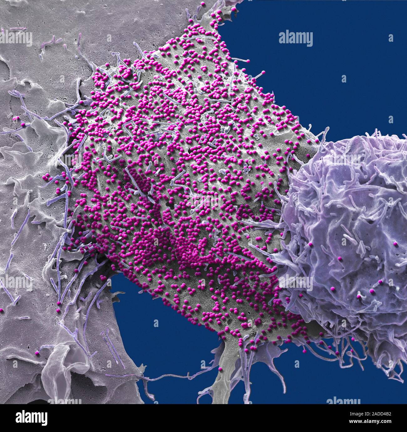 HIV infected 293T cell. Coloured scanning electron micrograph (SEM) of ...
