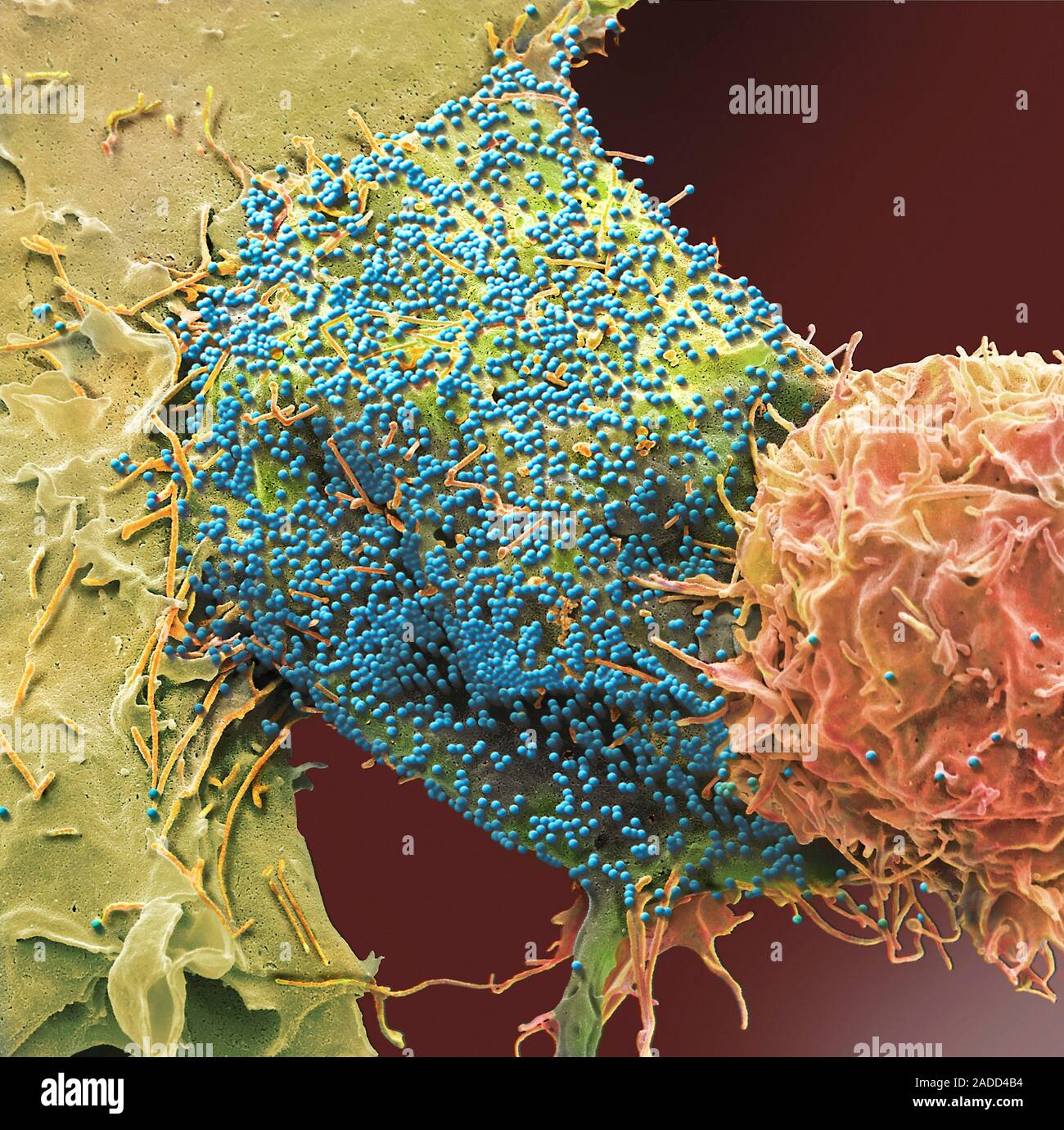 HIV infected 293T cell. Coloured scanning electron micrograph (SEM) of ...