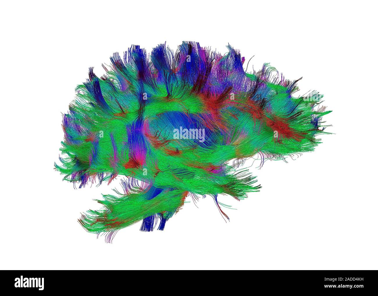 Diffusion tensor imaging (DTI) scan. Reconstructed brain white matter ... Diffusion tensor imaging (DTI) scan. Reconstructed brain white matter ...