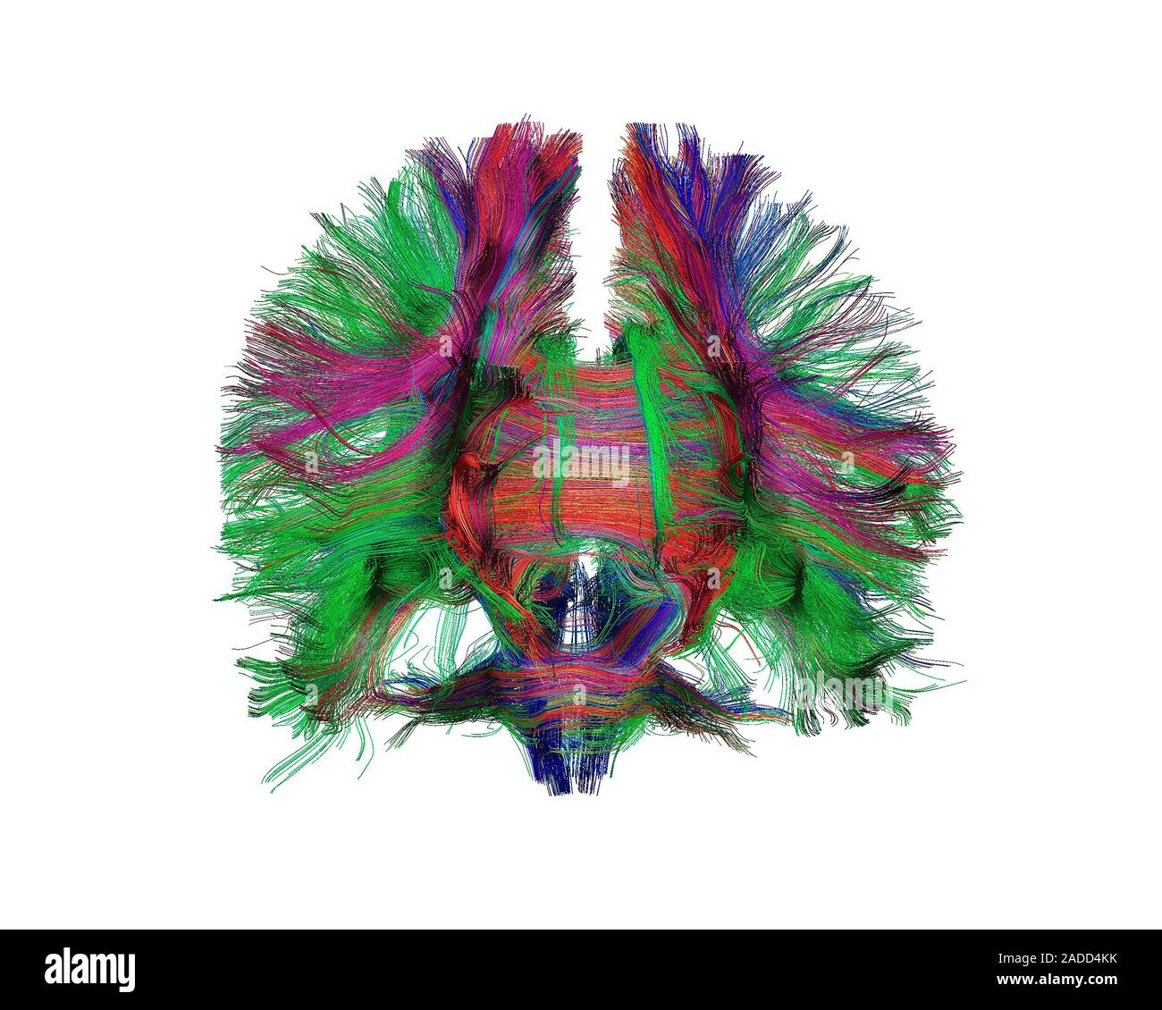 Diffusion tensor imaging (DTI) scan. Reconstructed brain white matter ... Diffusion tensor imaging (DTI) scan. Reconstructed brain white matter ...