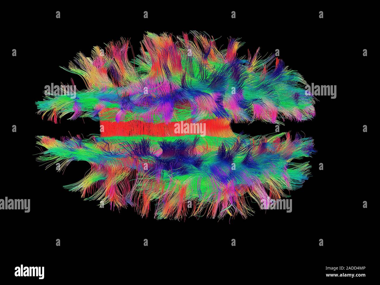 Diffusion tensor imaging (DTI) scan. Reconstructed brain white matter ... Diffusion tensor imaging (DTI) scan. Reconstructed brain white matter ...