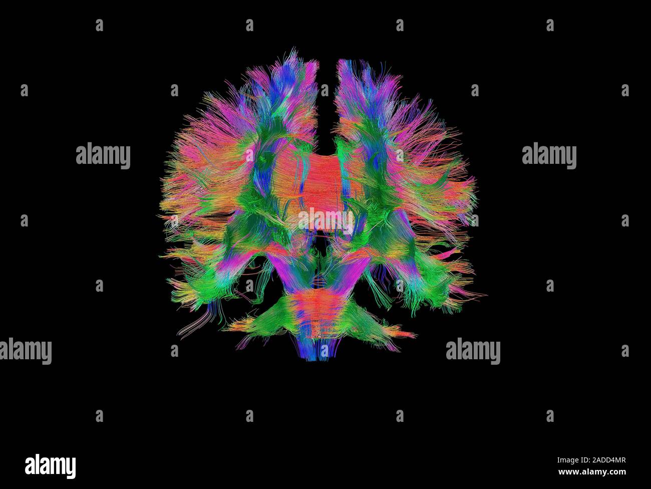 Diffusion tensor imaging (DTI) scan. Reconstructed brain white matter fibres of the whole brain ...