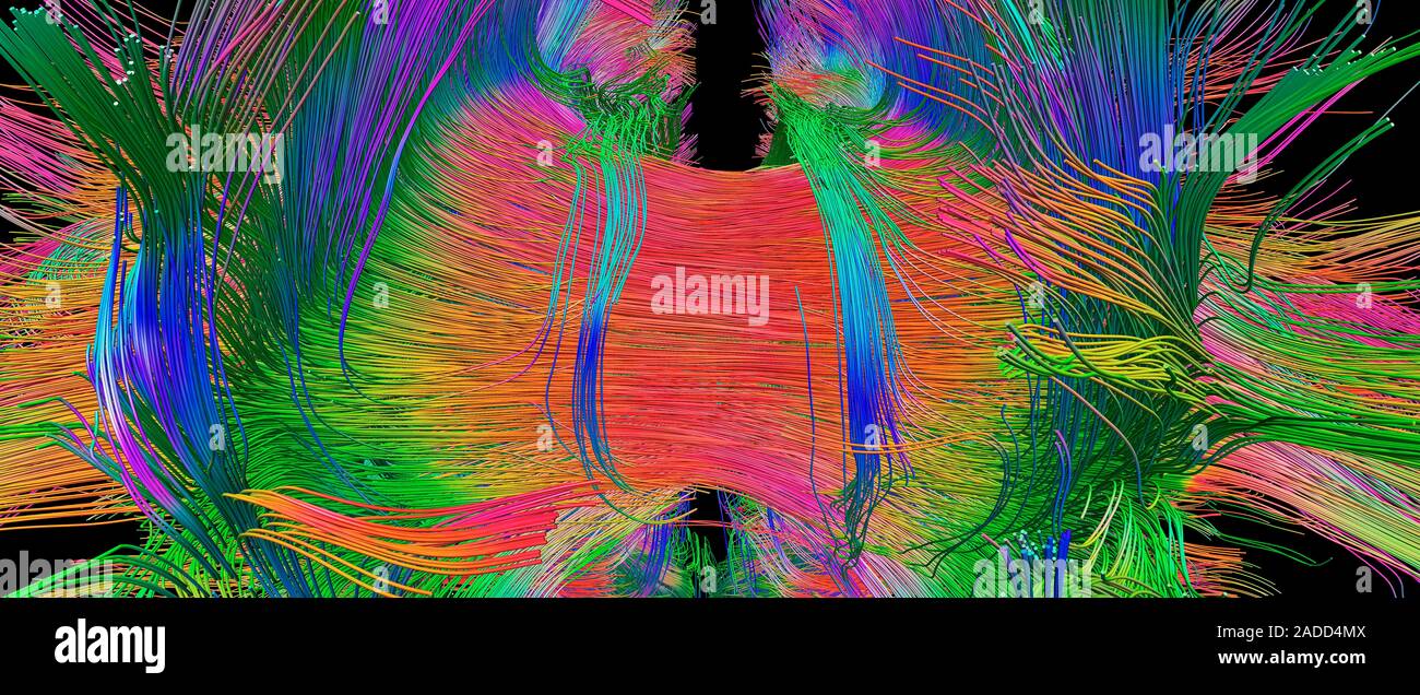 Diffusion tensor imaging (DTI) scan. Reconstructed brain white matter fibres of the whole brain ...