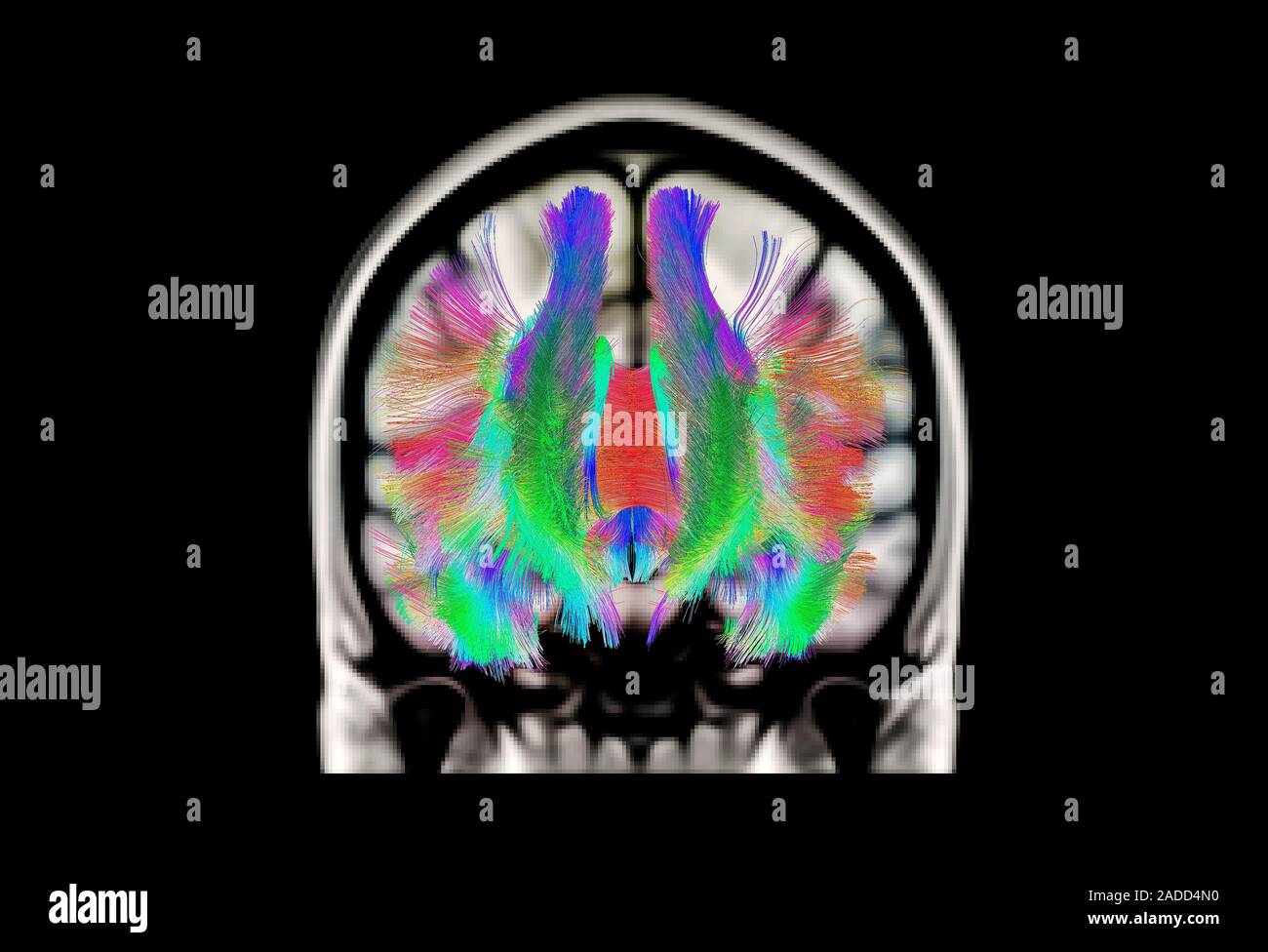 Diffusion tensor imaging (DTI) scan. Reconstructed brain white matter fibres of the whole brain ...