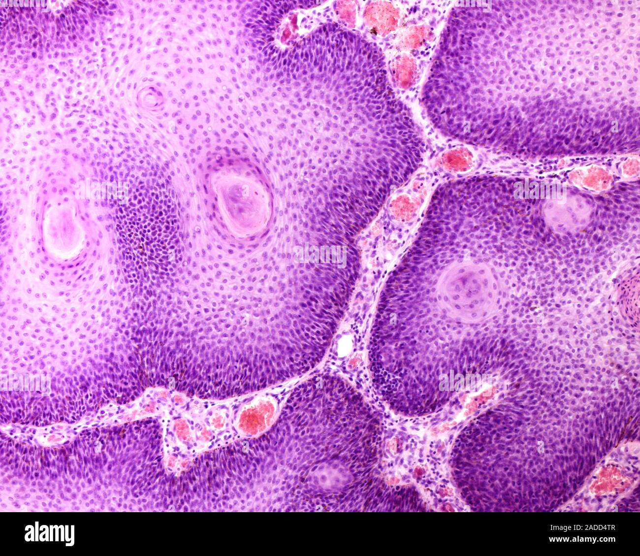 Papilloma of the larynx, light micrograph. This is a benign epithelial ...