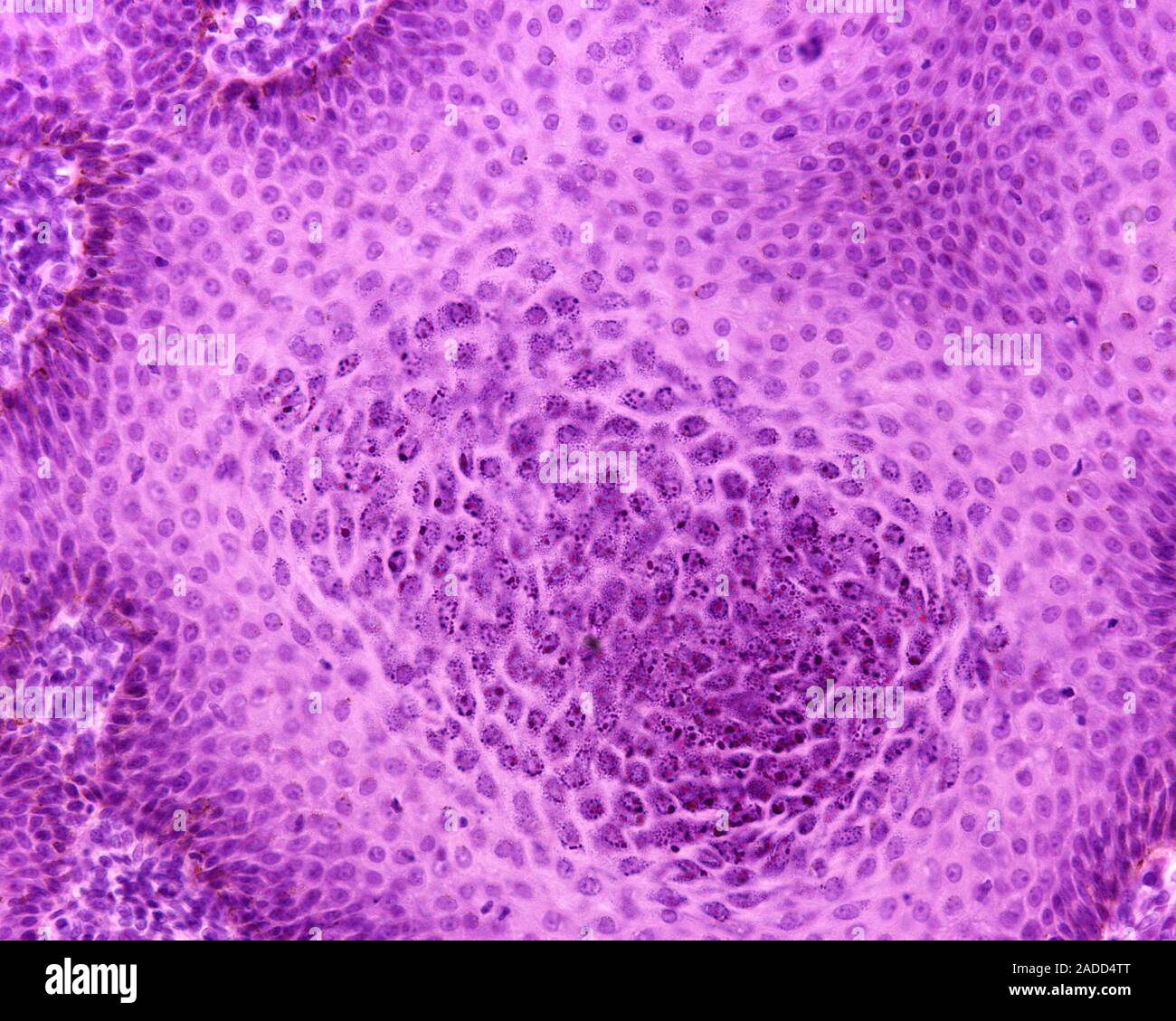Papilloma of the larynx, light micrograph. This is a benign epithelial ...