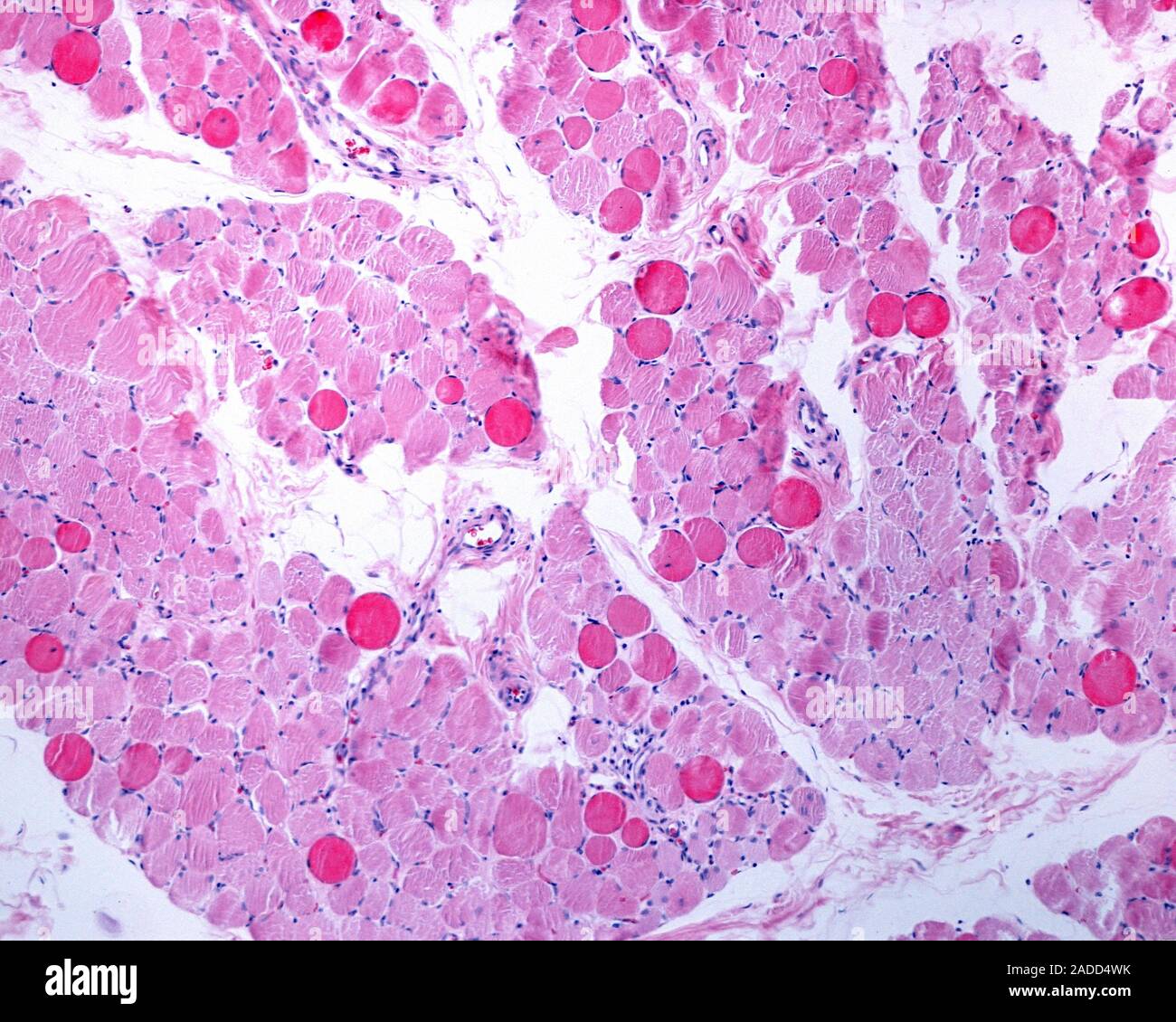 Muscular dystrophy, light micrograph. The key pathologic change of the ...