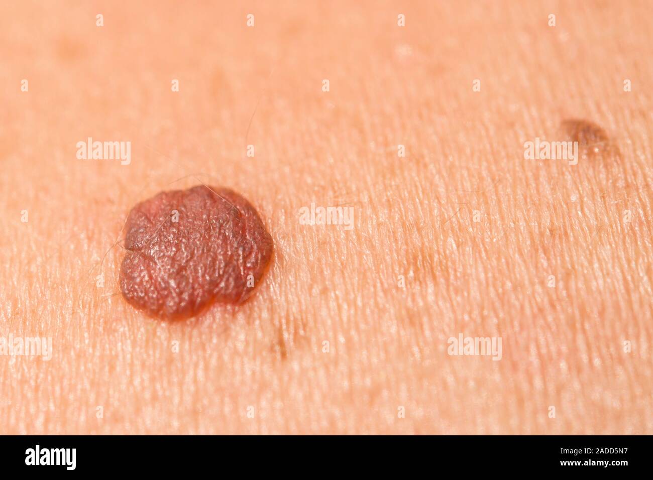 Mole on woman's back due to exposure to sun that needs to be kept under ...