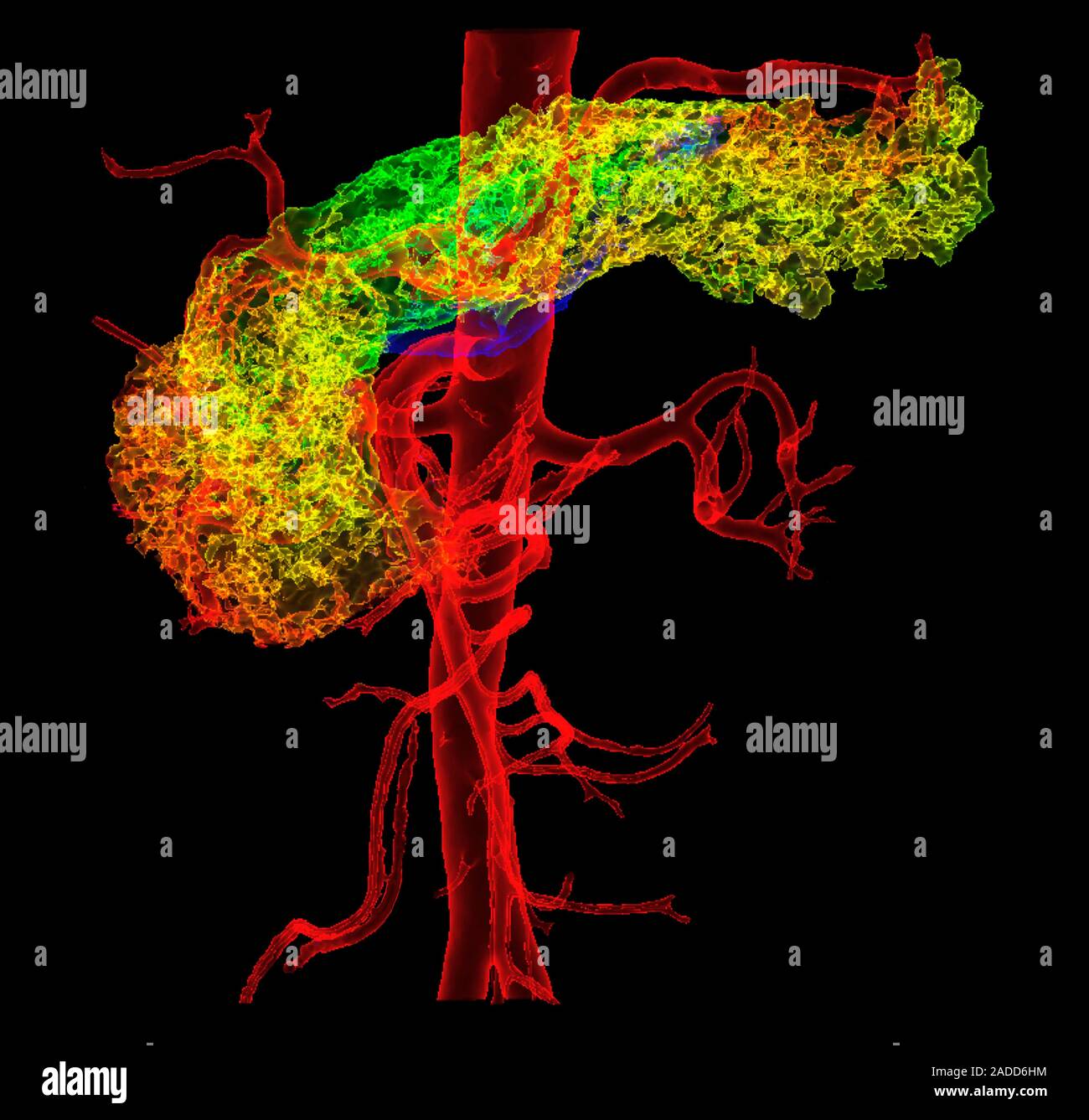 Pancreas and aorta. Coloured 3D frontal computed tomography (CT) scan ... Pancreas and aorta. Coloured 3D frontal computed tomography (CT) scan ...
