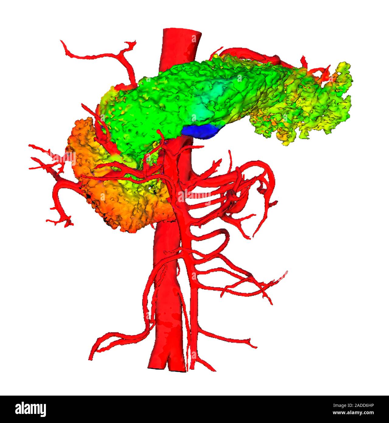 Pancreas and aorta. Coloured 3D frontal computed tomography (CT) scan ... Pancreas and aorta. Coloured 3D frontal computed tomography (CT) scan ...