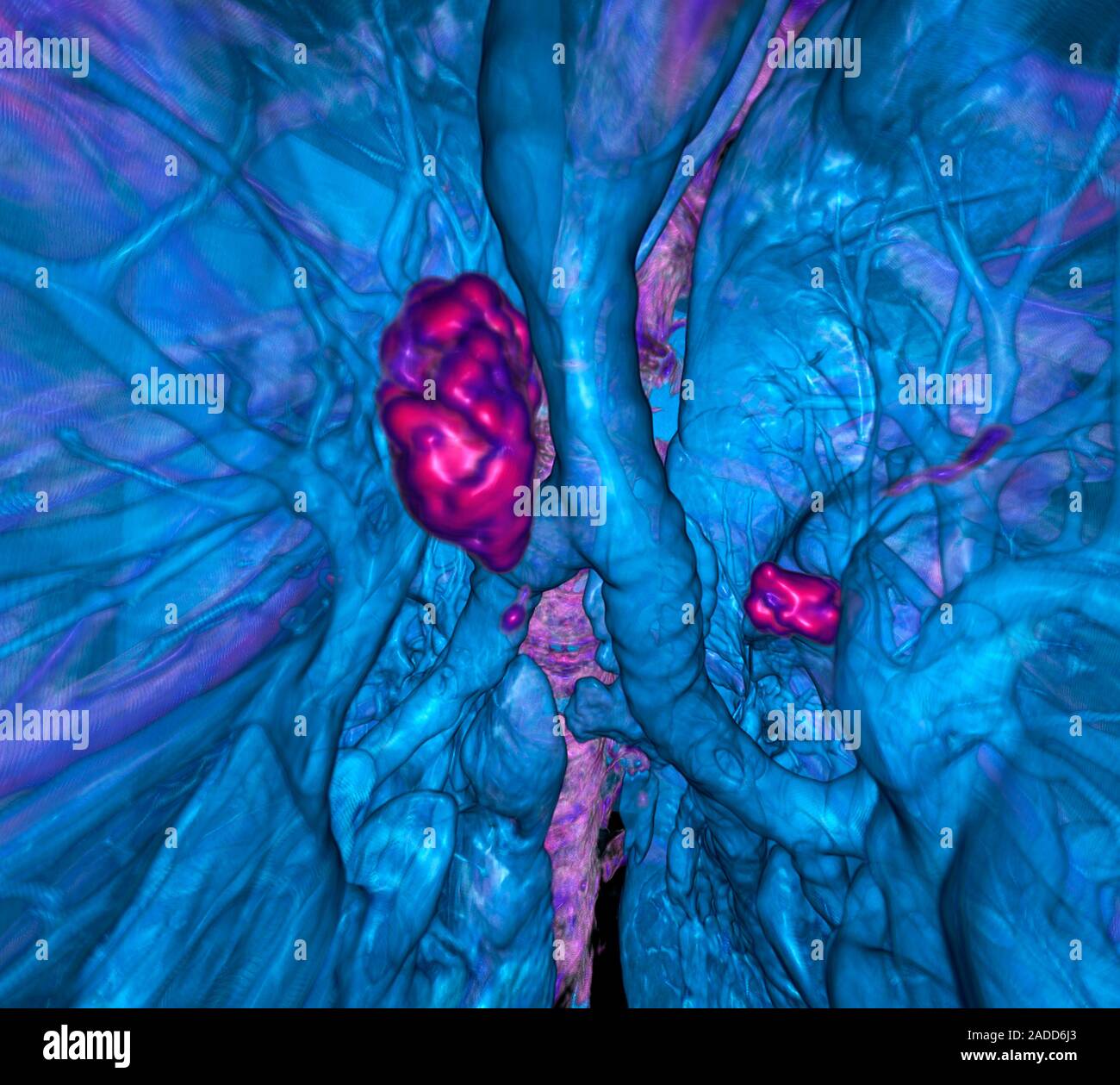 Calcified Lung Lymph Nodes Coloured 3d Computed Tomography Ct Scan