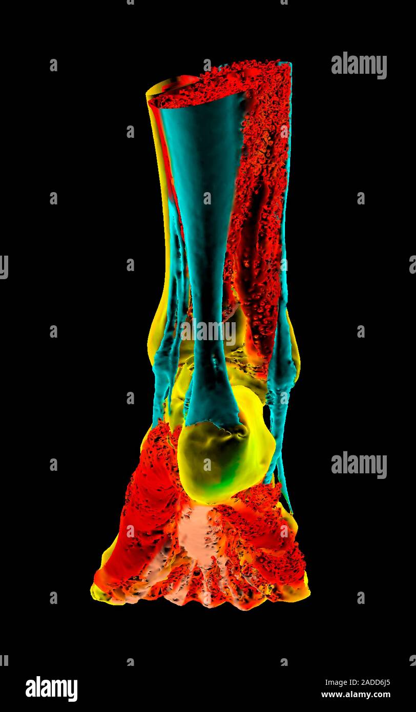 Human foot and Achilles tendon, 3D coloured computed tomography (CT ...