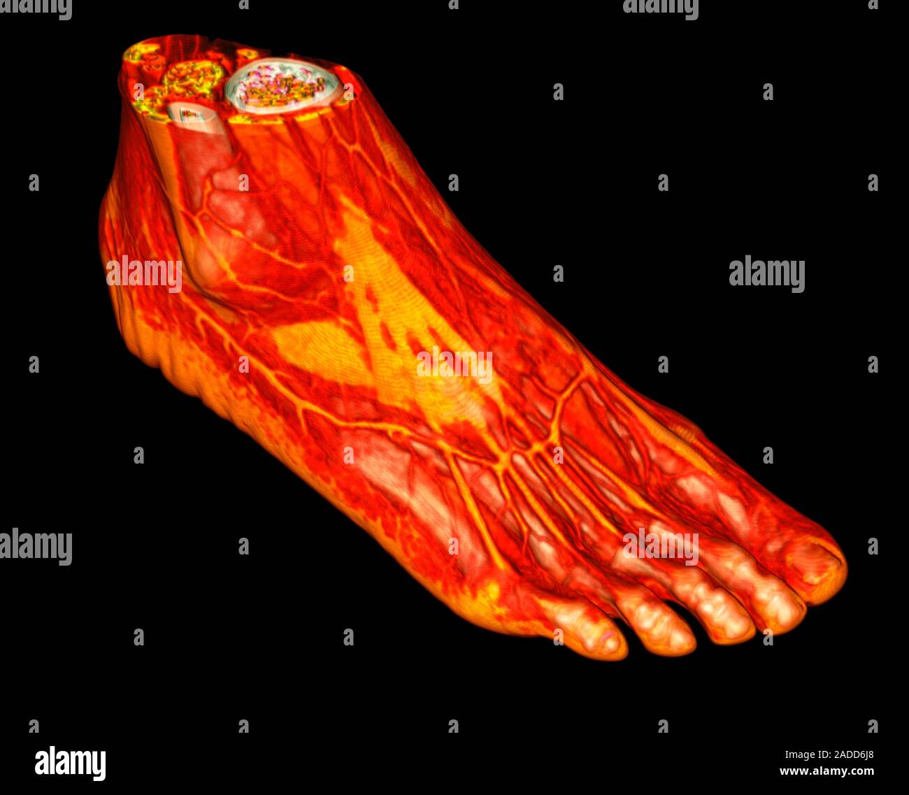 Human ankle and foot, 3D coloured computed tomography (CT) scan. This ...