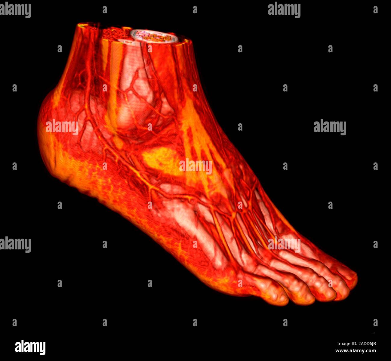 Human ankle and foot, 3D coloured computed tomography (CT) scan. This ...