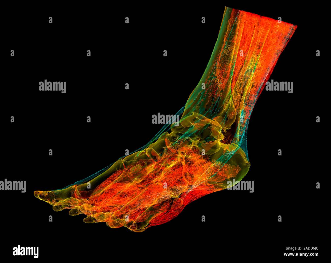 Human ankle and foot, 3D coloured computed tomography (CT) scan. This ...