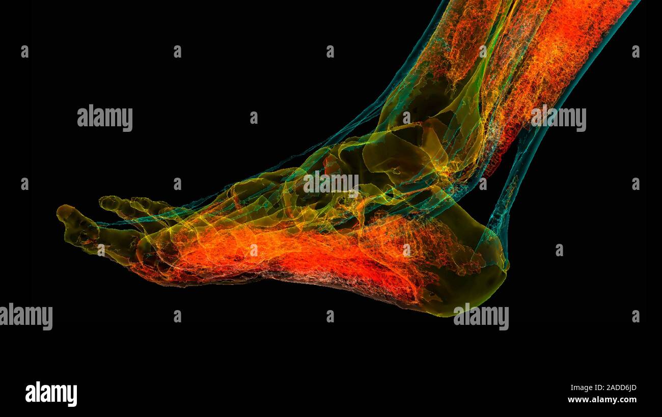 Human ankle and foot, 3D coloured computed tomography (CT) scan. This ...