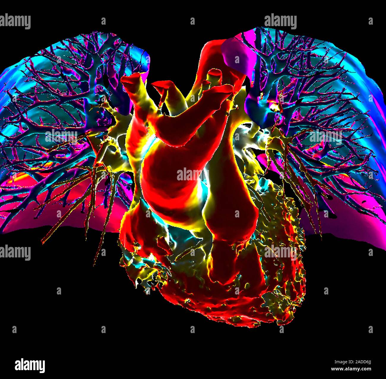 Human heart, 3D coloured computed tomography (CT) angiogram, with the ...