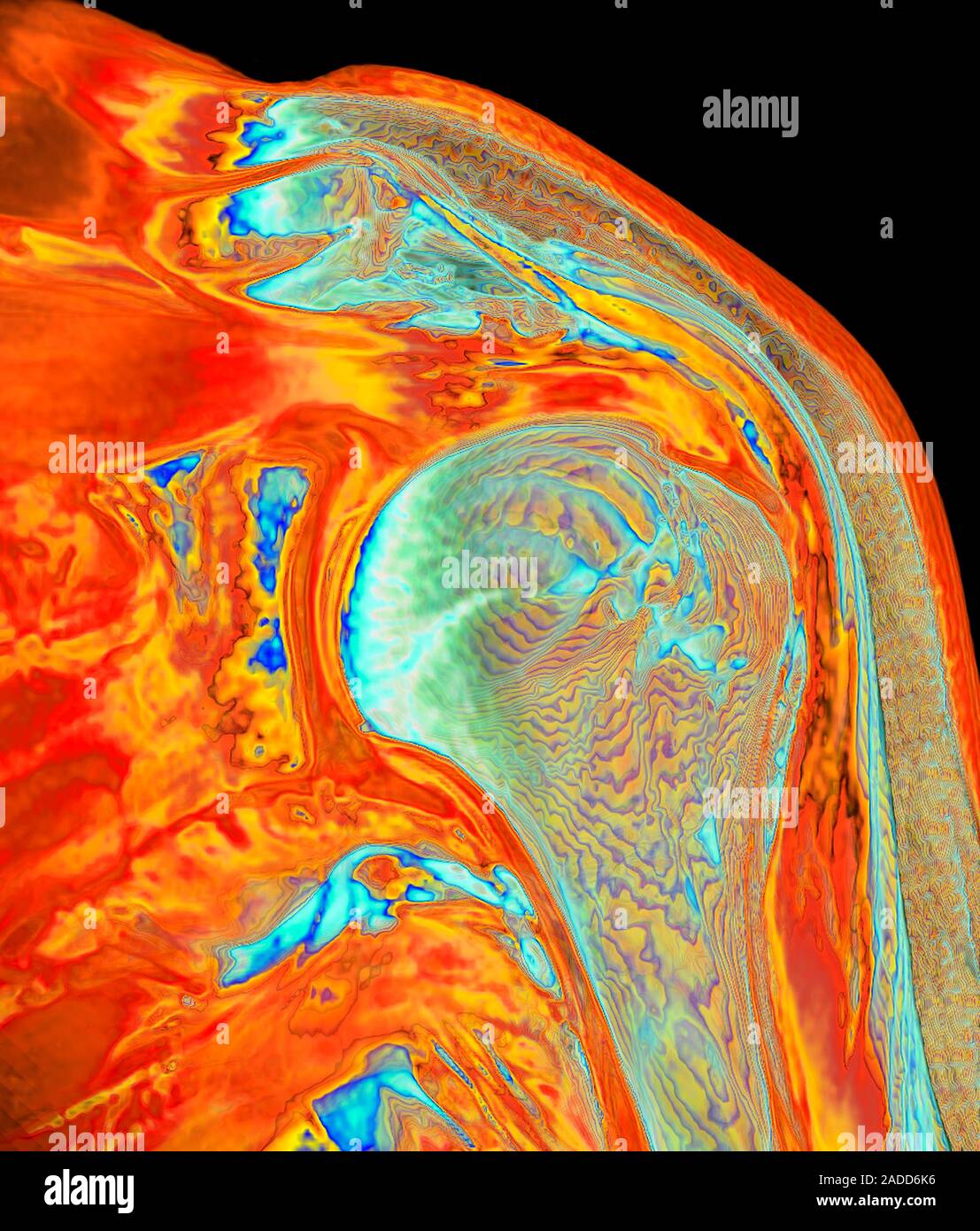 Frozen shoulder. Coloured sagittal magnetic resonance imaging (MRI ...