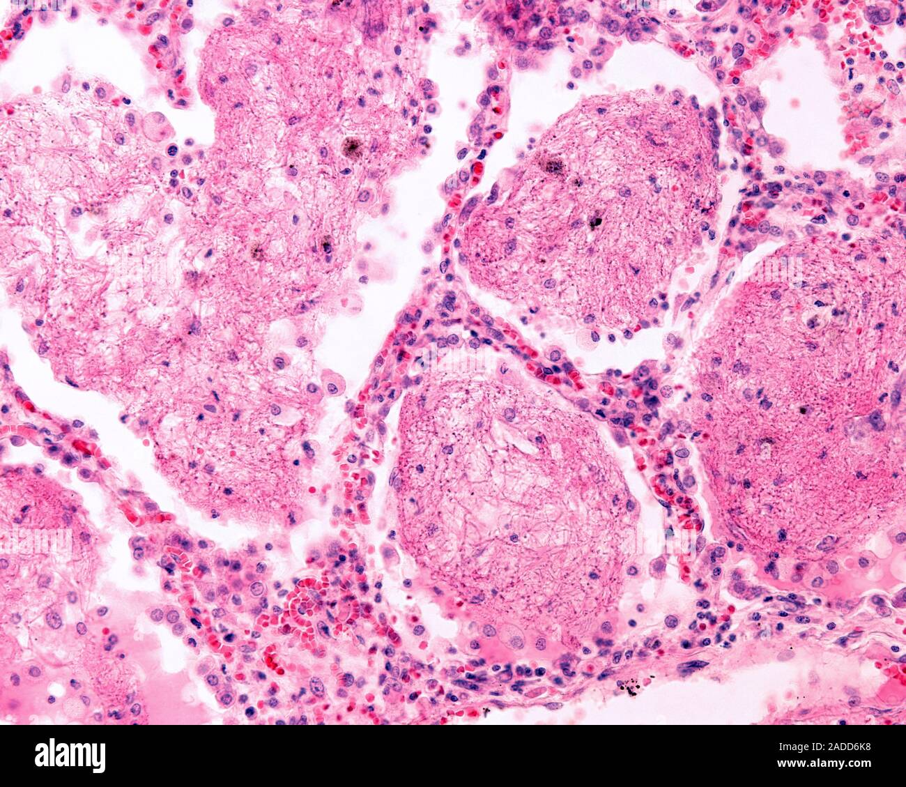 High magnification light micrograph of a human lung affected by ...