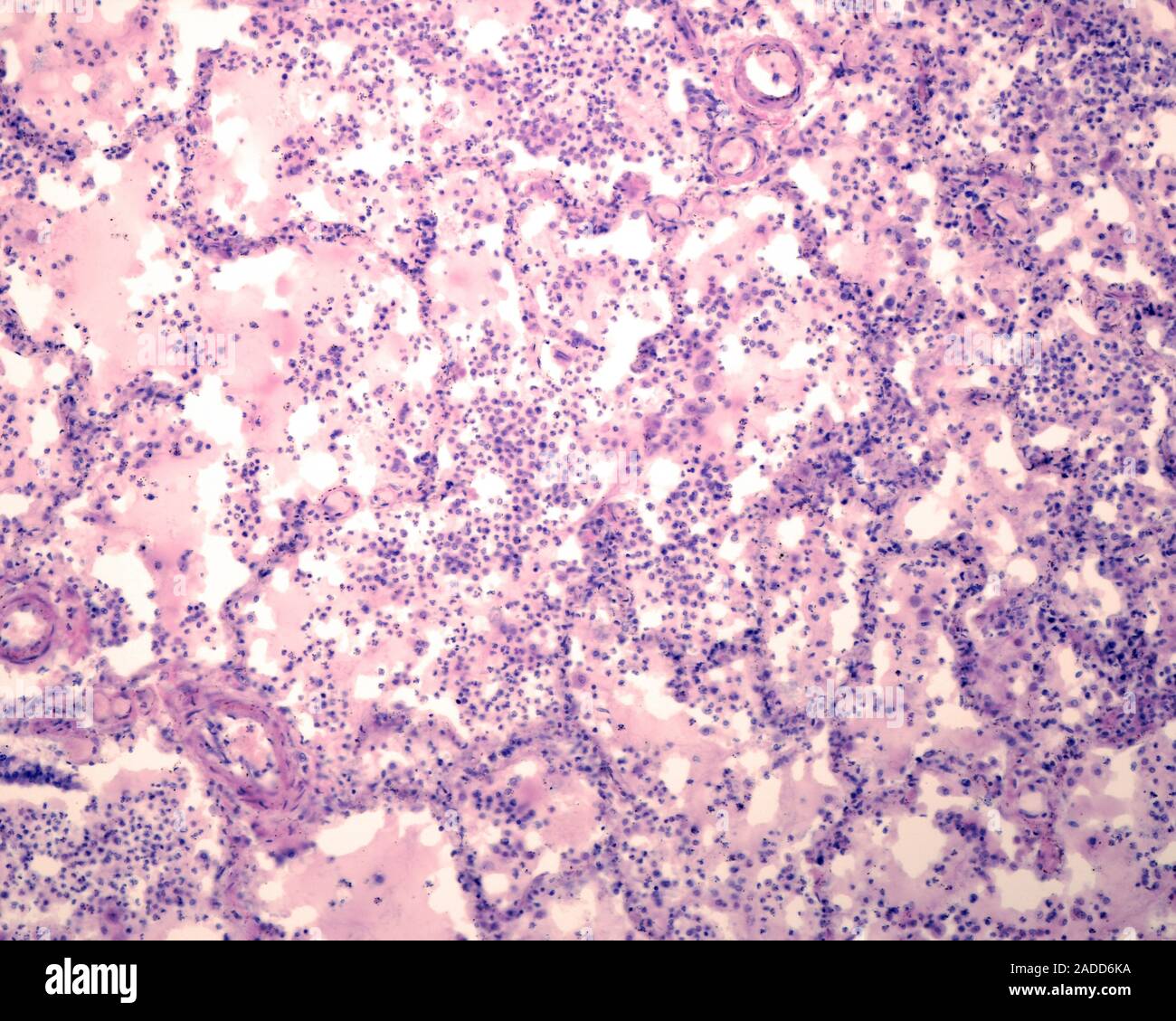 High magnification light micrograph of a human lung affected by an ...