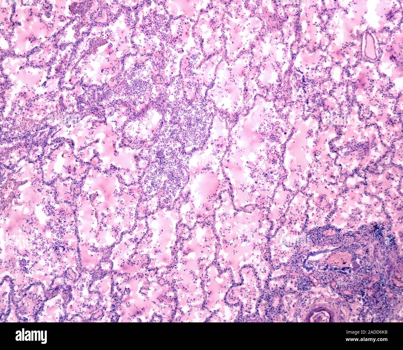 Very low magnification light micrograph of a human lung affected by an ...