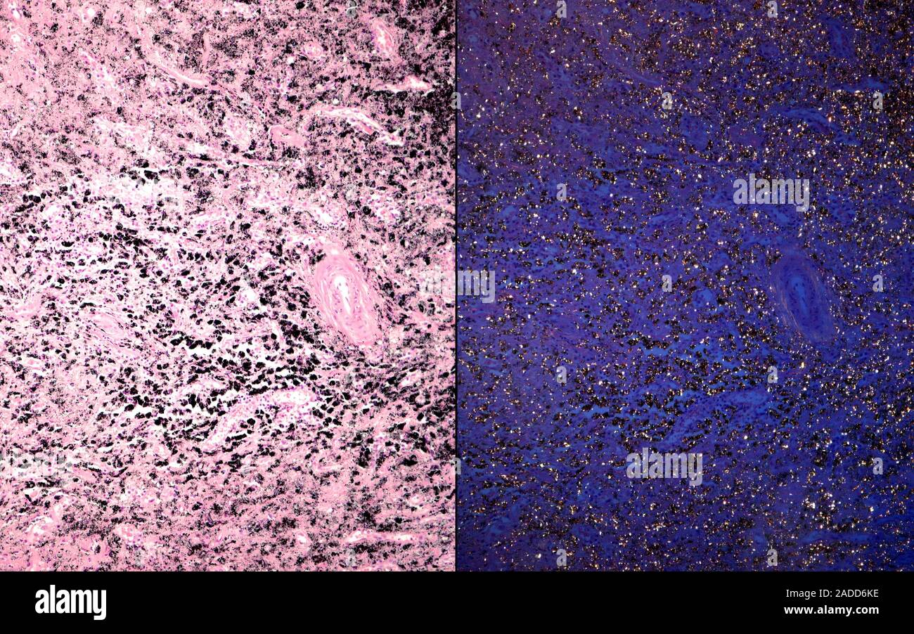 Lung silicosis. Sample of lung tissue with silicosis observed with ...