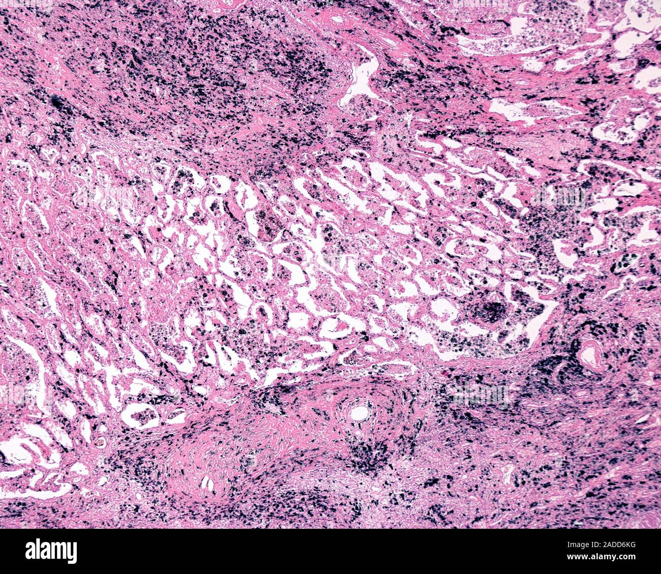 Silicotic lung, light micrograph. There is fibrosis and anthracosis in ...