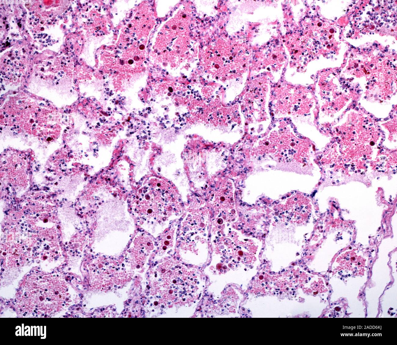 Light micrograph of a human lung affected by an acute pneumonia. The ...